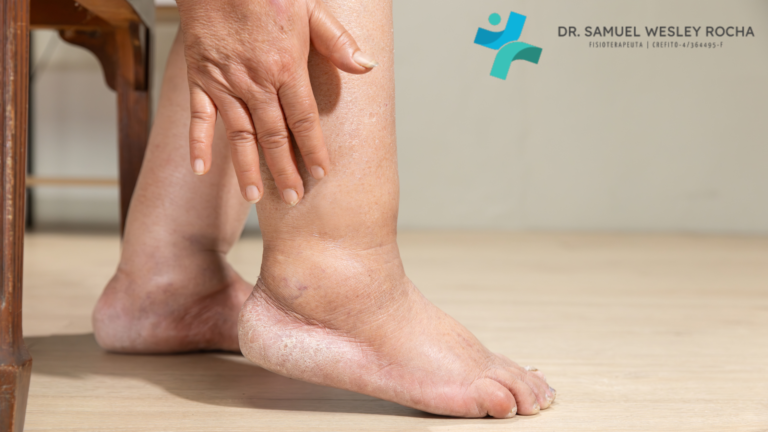 Edema: O que é o Sinal de Cacifo e como avaliar? » Blog
